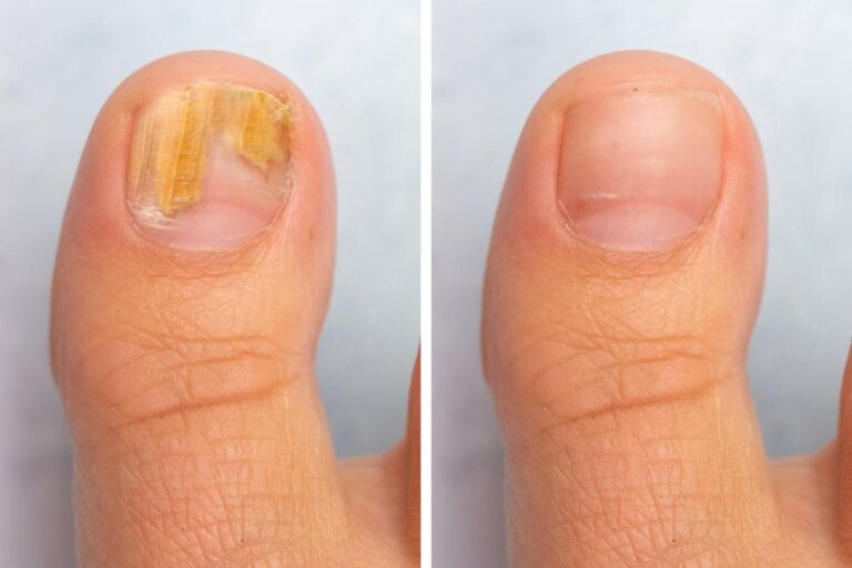 Early Stage Toenail Fungus: How to Identify and Stop It Fast ...