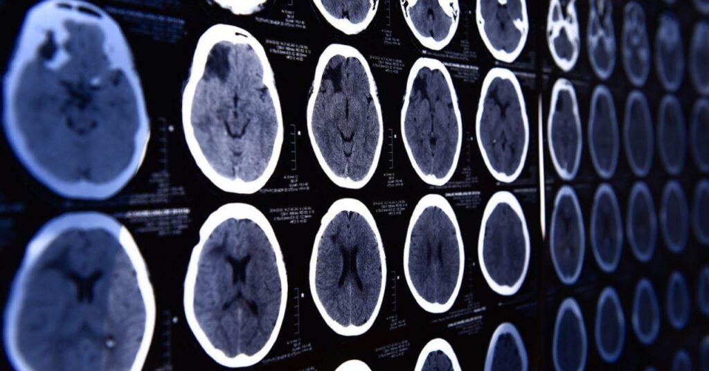 Central Nervous System Disorders: Top Symptoms & Warning Signs ...