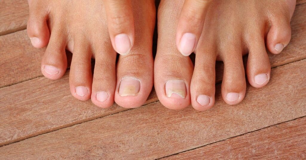 How Nail Polish Damage Toenails (3 Signs to Watch For) | PureHealth ...