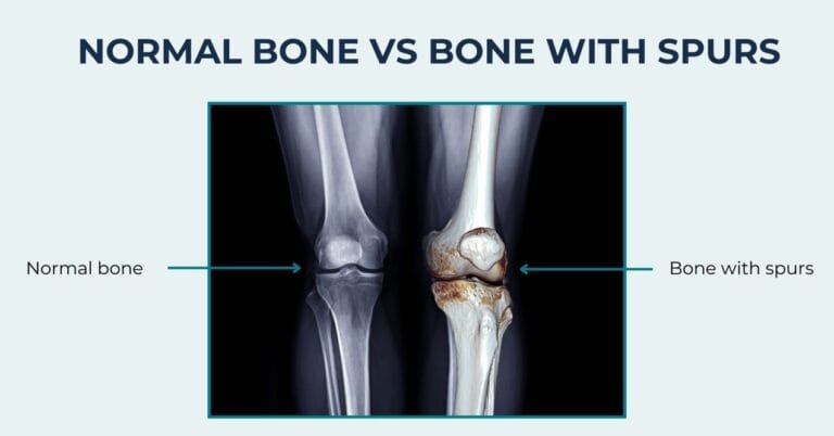 How to Dissolve Bone Spurs Naturally | PureHealth Research